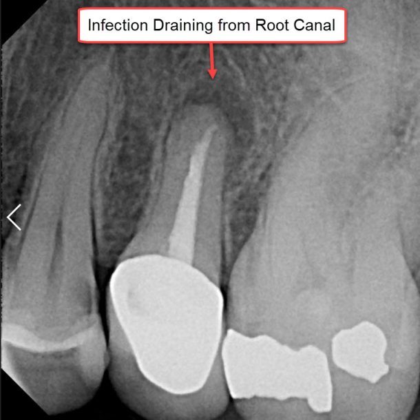 How to Resolve a Root Canal Infection - A Pardigm Shift - Integrative ...